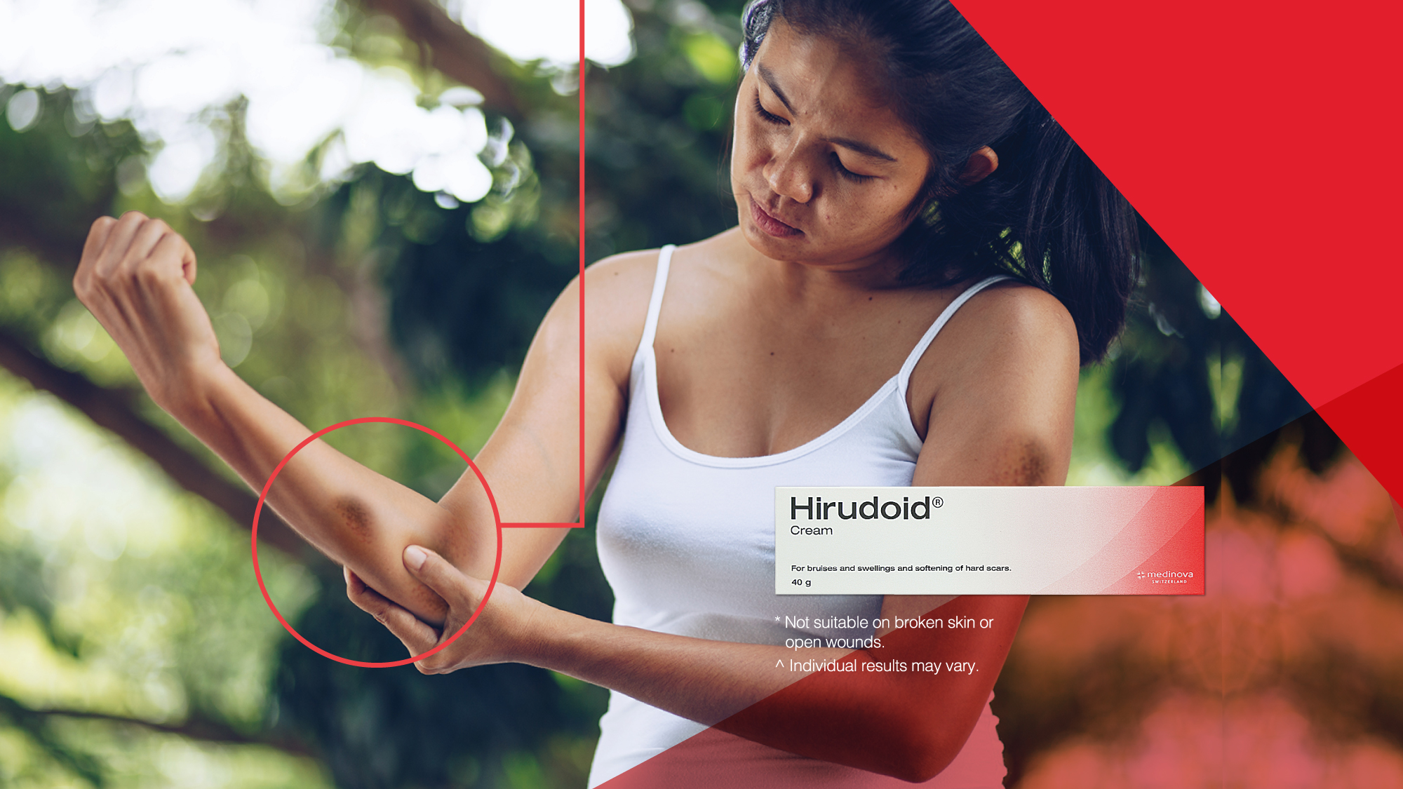 Hirudoid Cream/Gel for Bruises and Scars | Hiruscar Singapore